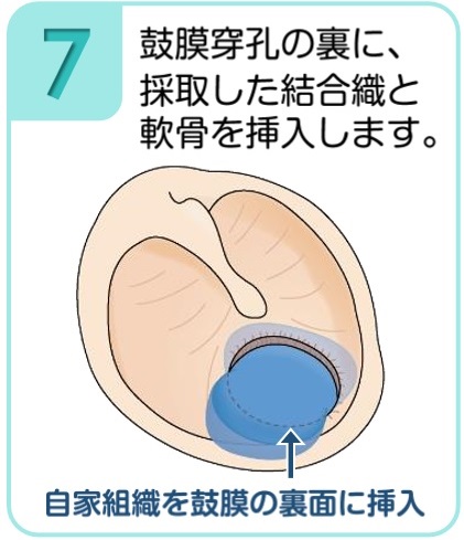 慢性中耳炎の手術｜痛みや手術費用｜尼崎市のかわもと耳鼻咽喉科クリニック